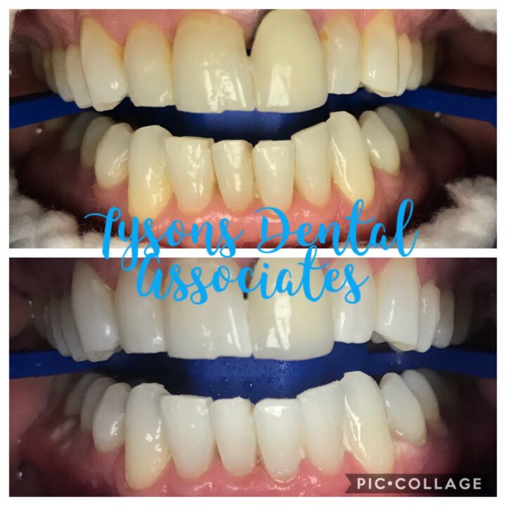 Teeth Whitening Tysons Corner Va | Teeth Whitening in Tysons Corner