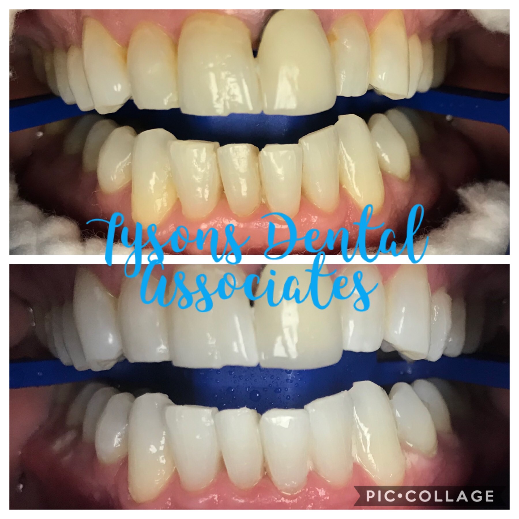 Teeth Whitening Tysons Corner Va | Teeth Whitening in Tysons Corner