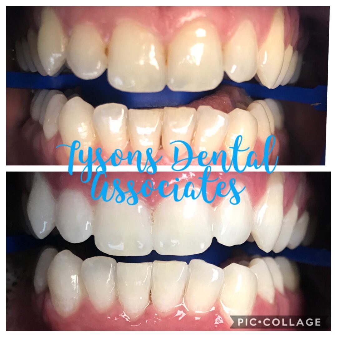 Teeth Whitening Tysons Corner Va | Teeth Whitening in Tysons Corner