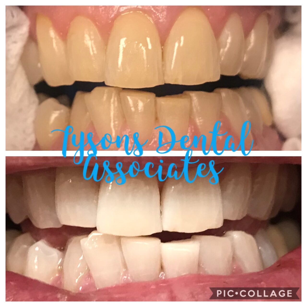 Teeth Whitening Tysons Corner Va | Teeth Whitening in Tysons Corner