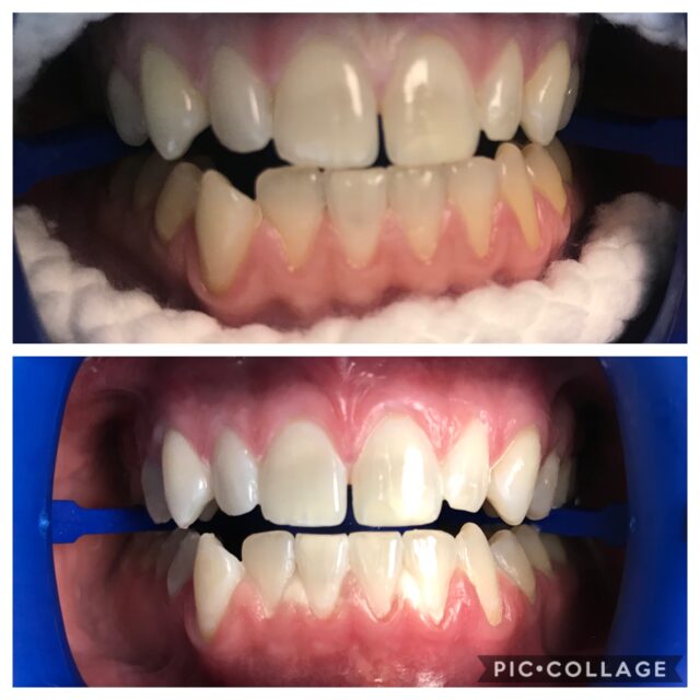 Teeth Whitening Tysons Corner Va | Teeth Whitening in Tysons Corner