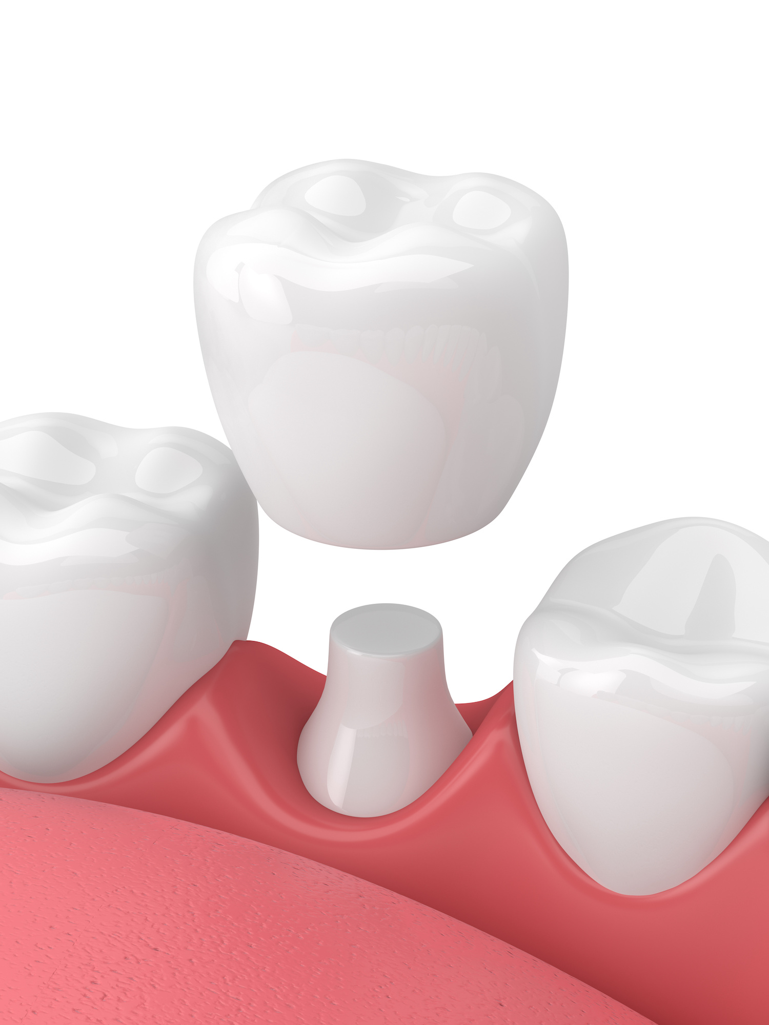 What You Need to Know About a Dental Crown - Dentist Tysons Corner VA ...